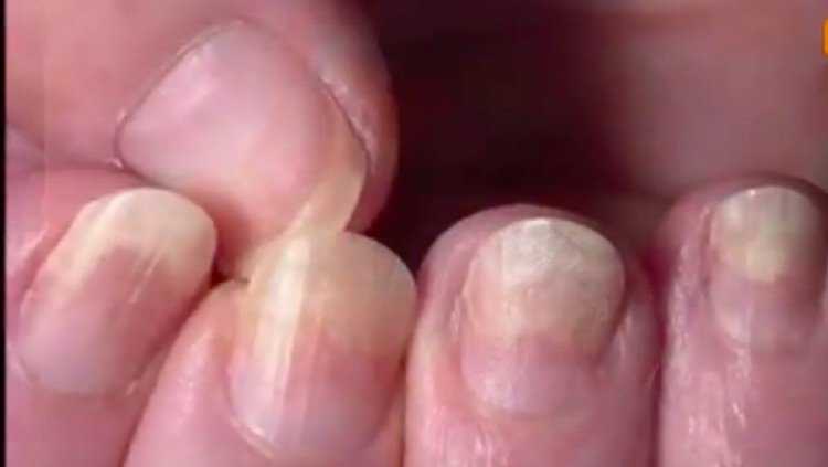 Here’s What it Means if Your Nails are Brittle, Spotted, Ridged or Broken