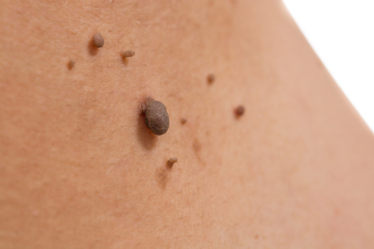 15 Natural Ways To Cure Skin Tags Warts And More