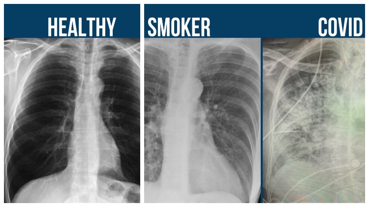 Healthy Vs Unhealthy Lung X Ray Hot Sex Picture