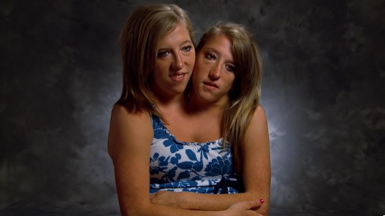 These Conjoined Twins Are Now All Grown Up And Have Made An Important ...