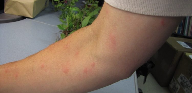 What Your Reaction to a Mosquito Bite Reveals About You and Your Health