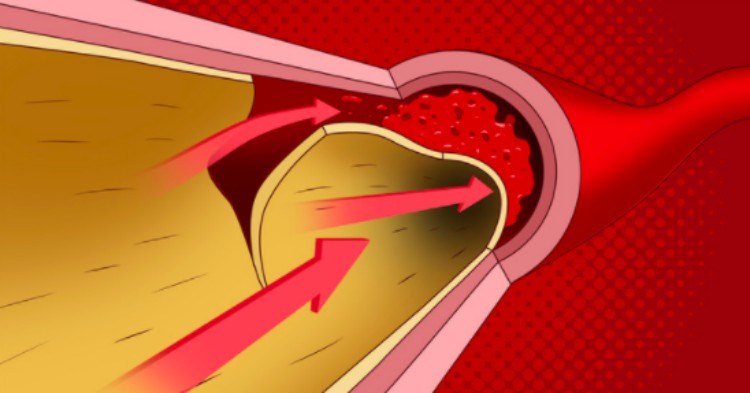 Here’s What You Need to Know About SCAD, a Leading Cause of Heart ...