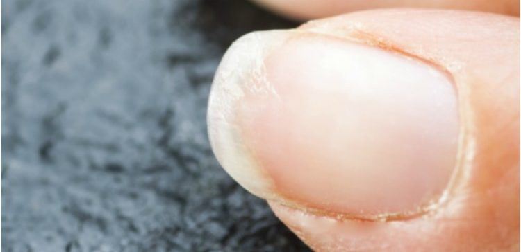 Here’s What it Means if Your Nails are Brittle, Spotted, Ridged or Broken