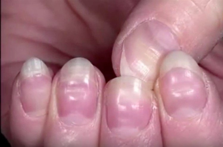 Here’s What it Means if Your Nails are Brittle, Spotted, Ridged or Broken