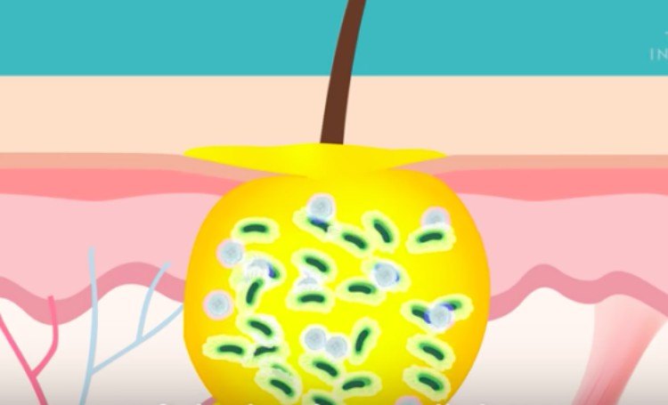 This Is What’s Inside A Pimple