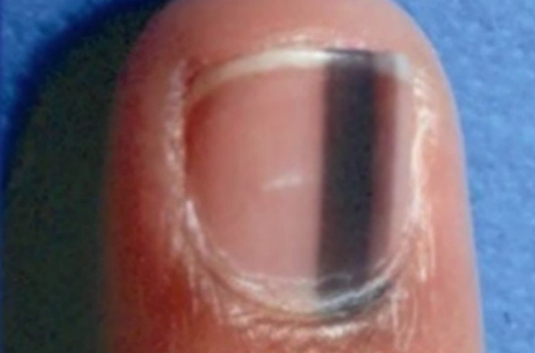 Here’s What it Means if Your Nails are Brittle, Spotted, Ridged or Broken
