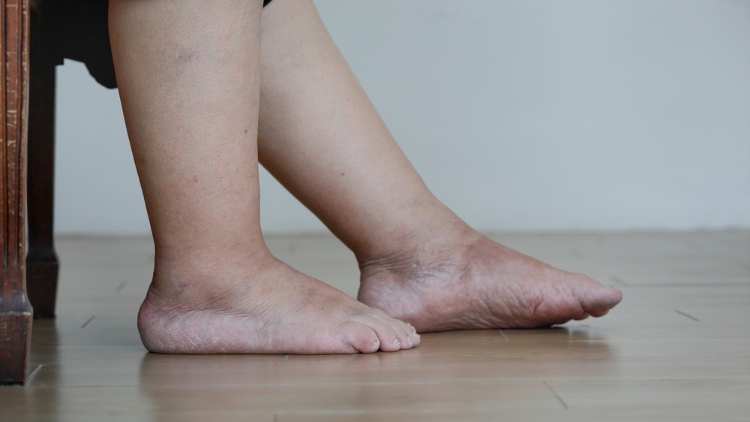 6 Easy Ways to Heal and Relieve Swollen Limbs