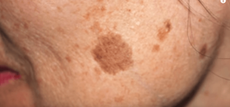 Simple Trick To Remove Brown Spots From Your Skin