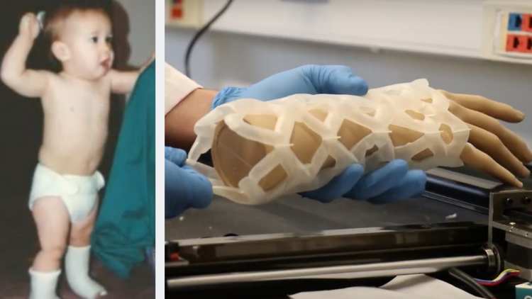 Engineer Who Has Worn Over 50 Casts in His Lifetime Helped Create ...