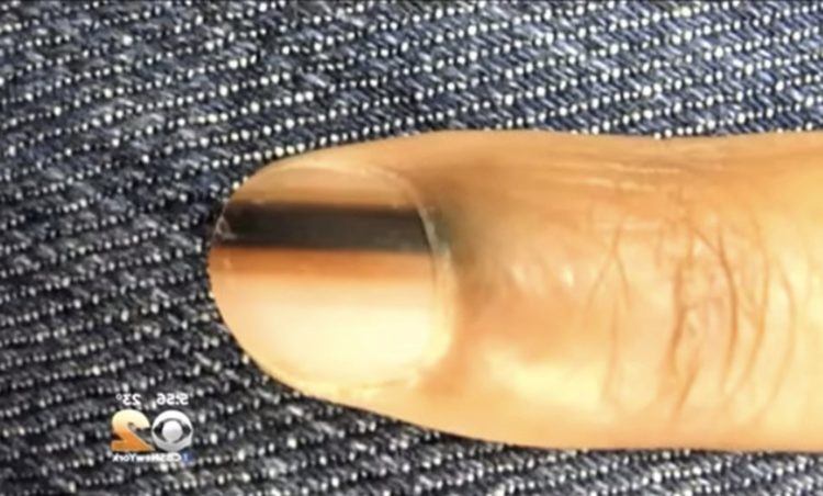 Here’s Why You Should See a Doctor If You Notice Black On Your Nail