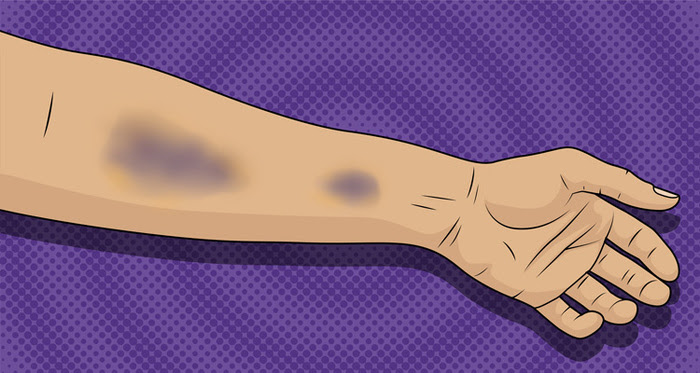 Do You Get Bruises Easily? Here Are 7 Things That Might Be to Blame