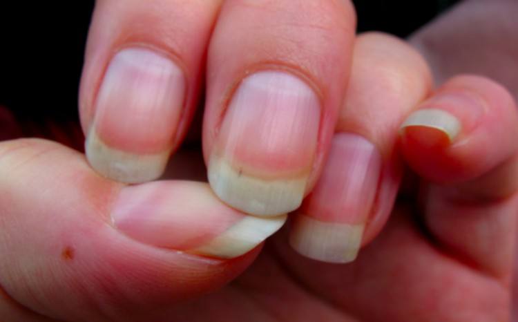 5 Health Issues You Can See on Your Fingernails