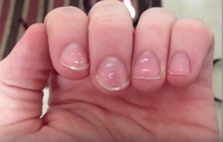 Here’s What it Means if Your Nails are Brittle, Spotted, Ridged or Broken