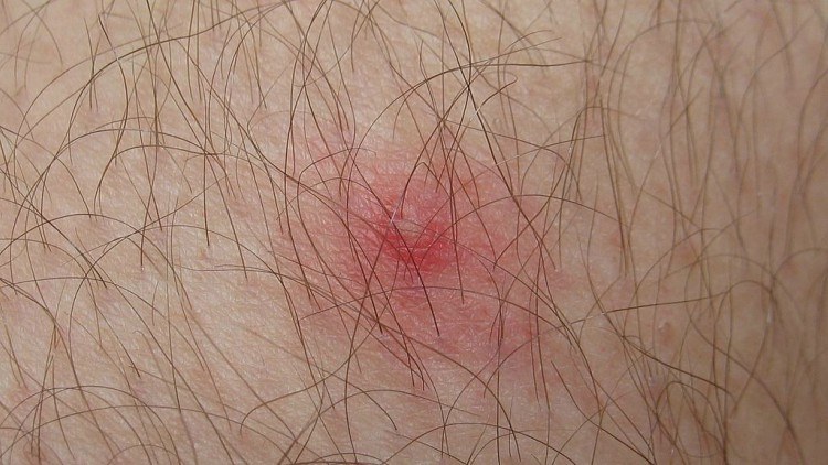 What Bug Bit You and How to Treat It