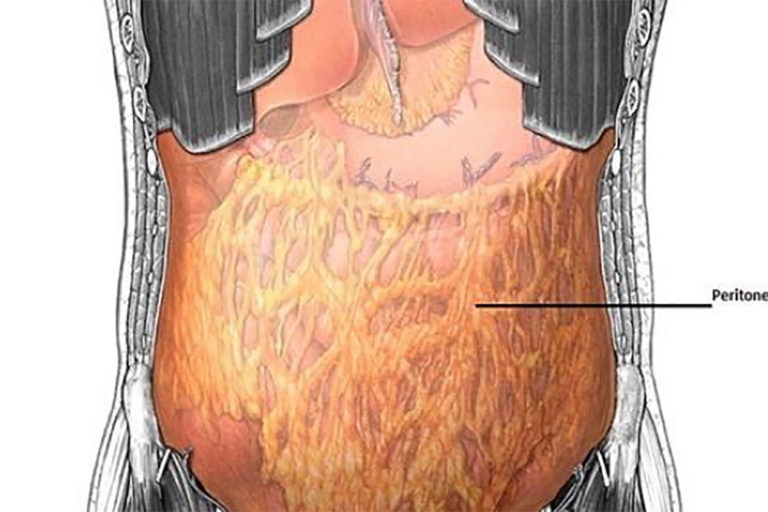Câncer de peritônio: conheça os sintomas e os tipos de tratamento ...