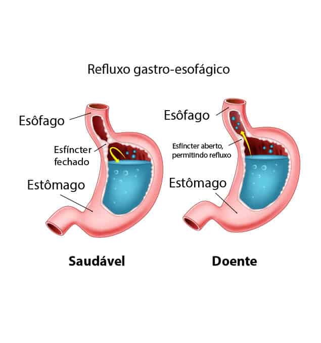 Refluxo gástrico: conheças as causas, sintomas e tratamento – Portal do ...