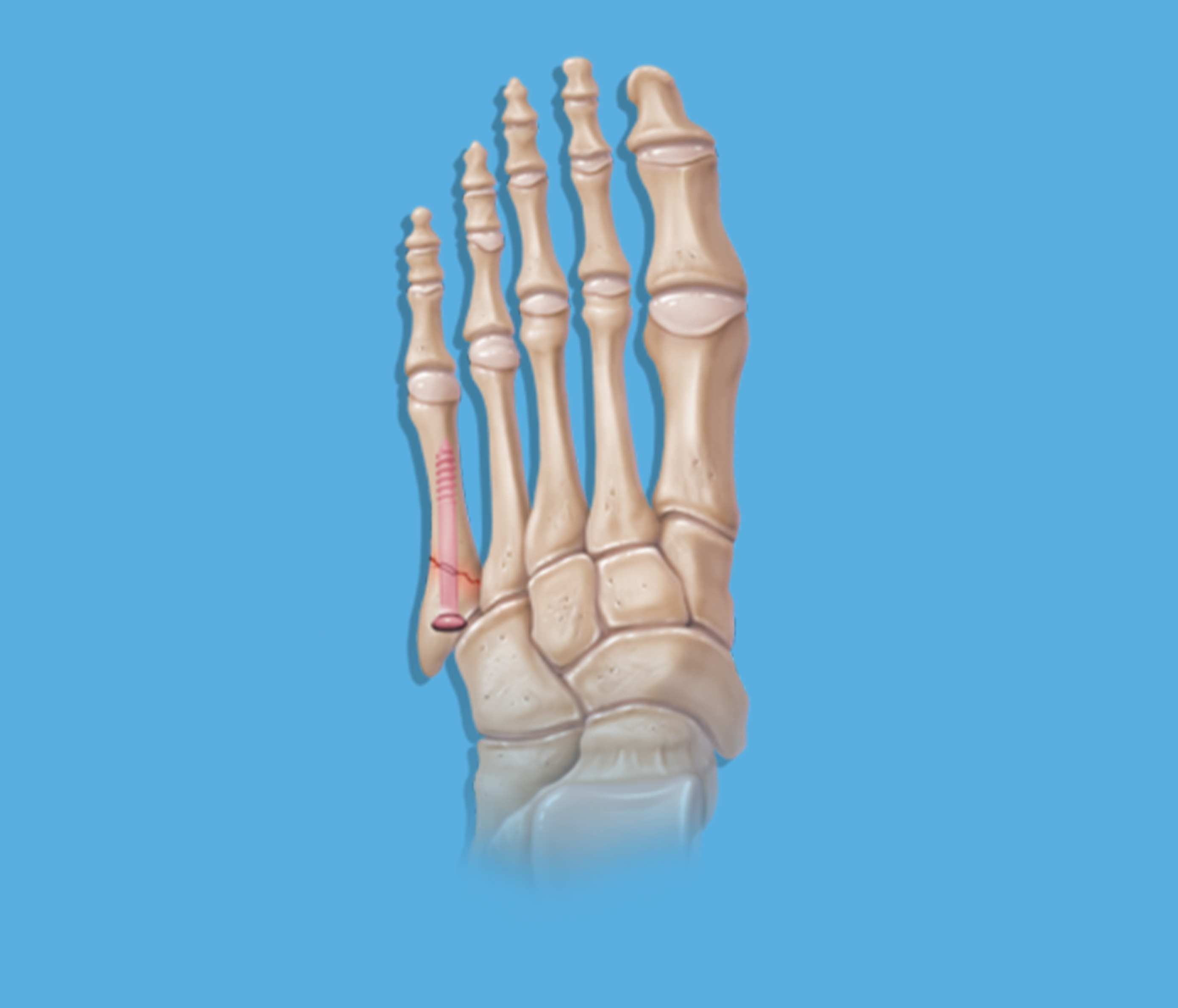 Cid 10 Fratura Metatarso - RETOEDU