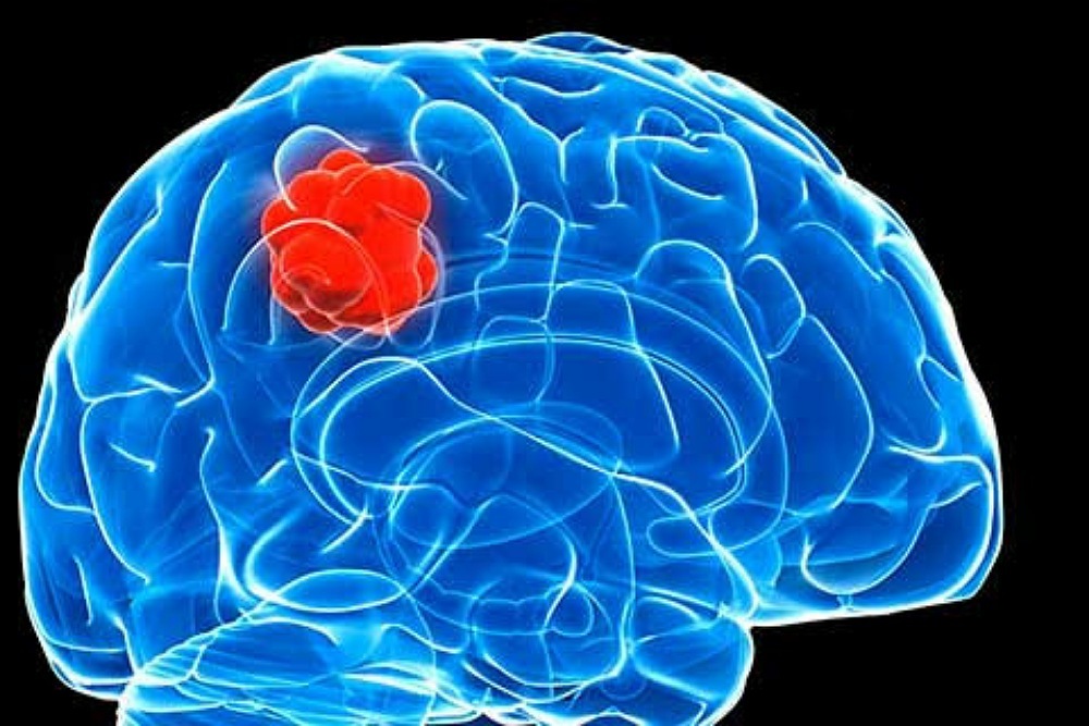 GBM Glioblastoma Multiforme Treatments Advancing As FDA Steps Up