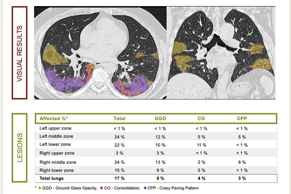 ICOMETRIX: FDA permits use of icometrix's AI-based quantification for ...