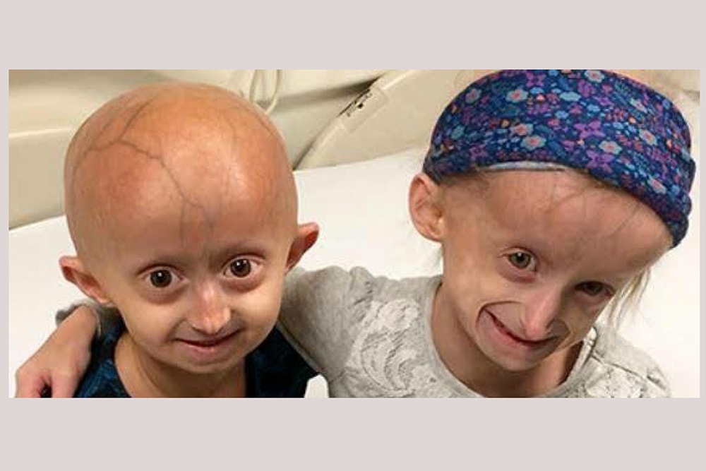 PROGERIA RESEARCH FOUNDATION: First-Ever Treatment for Rare Rapid-Aging ...