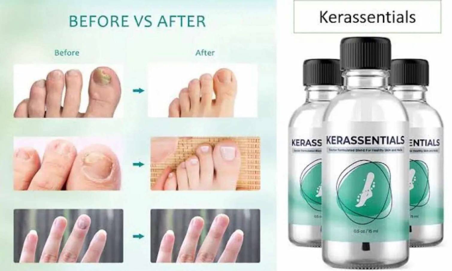 Kerassentials