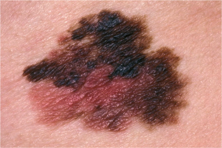 Melanoma tips: what to look for - Landmark Aesthetics | MedSpa Laser Center