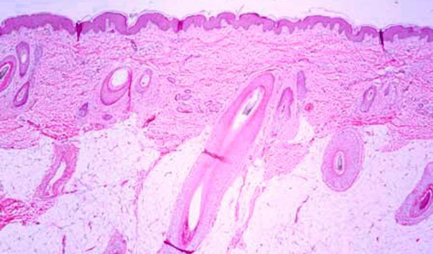 Blood and lymphatic capillaries grown in the lab enhance skin grafts