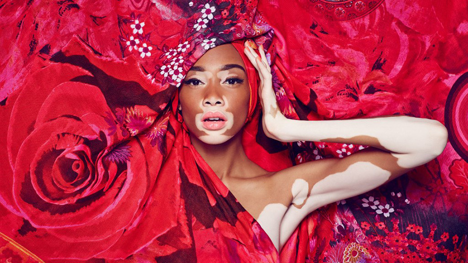 Modelo com vitiligo pra quebrar os tabus da moda - Lilian Pacce