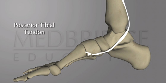 Posterior Tibial Tendon Dysfunction Pttd Symptoms