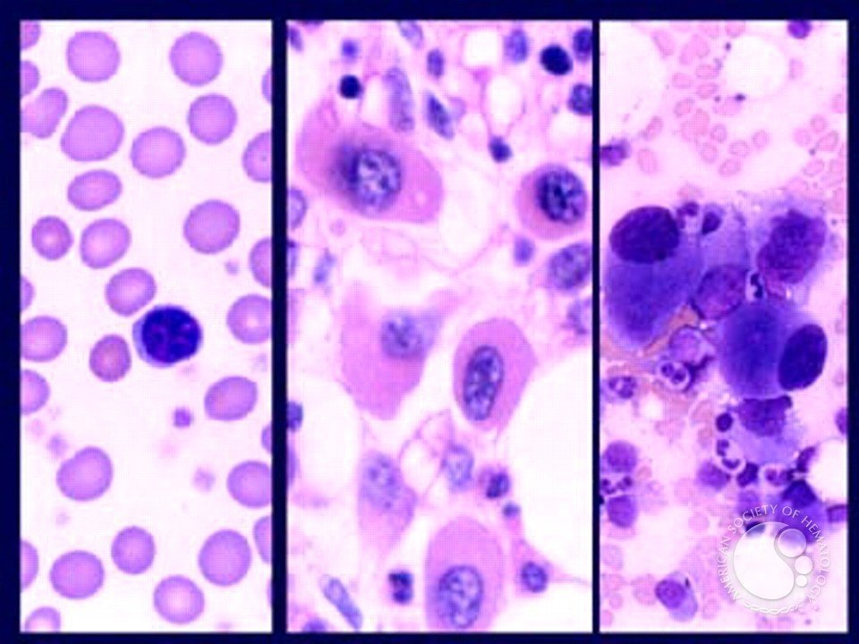 Copy of 5Q- Syndrome