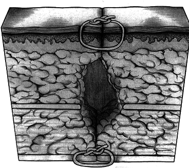 Wound Closure Solutions