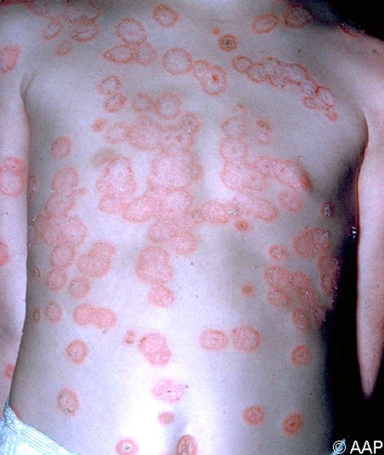 Skin Disease Project