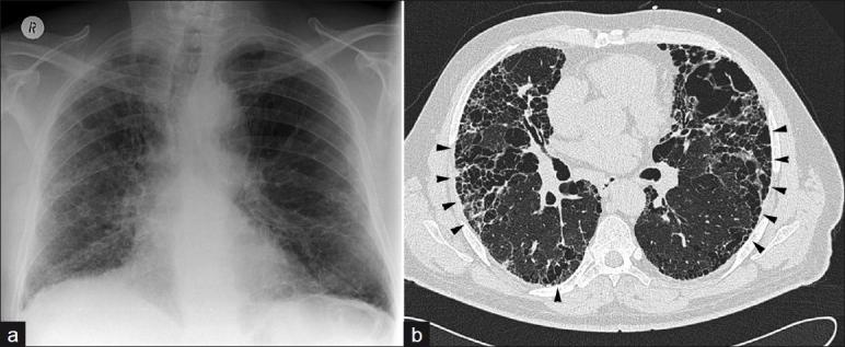 Rheumatoid Lung Disease