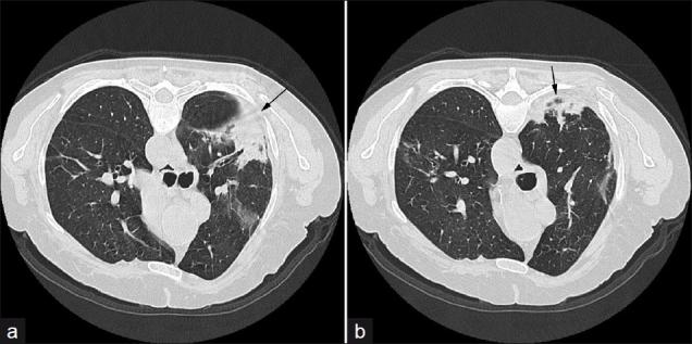 Rheumatoid Lung Disease
