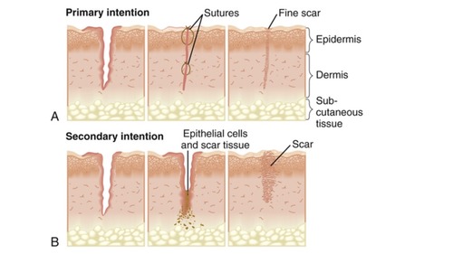 Indications And Contraindications For Suture Removal | MetaNESTA