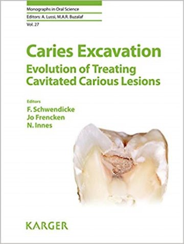 Campus Store : Caries Excavation: Evolution of Treating Cavitated ...