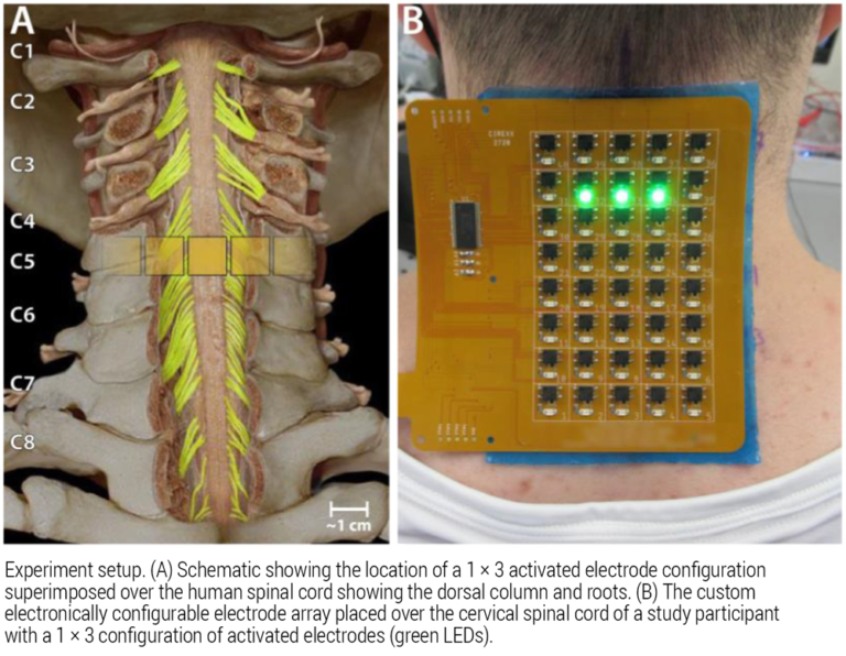 Case Study: Persistent Recovery of Hand Movement and Tactile Sensation ...