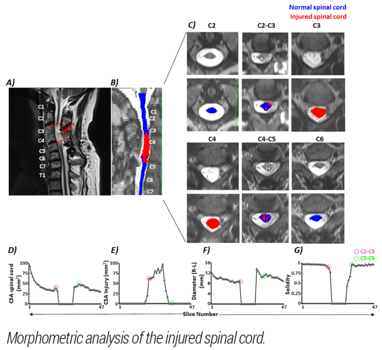 Multi-Site Spinal Cord Transcutaneous Stimulation Facilitates Upper ...