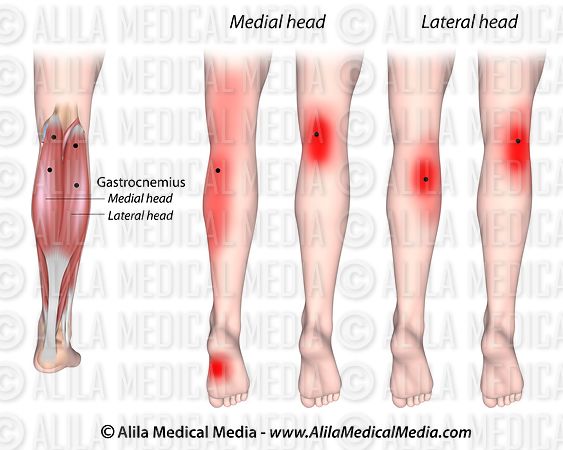 Alila Medical Media | Trigger points and referred pain for the ...