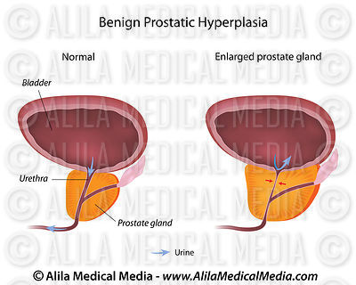 Alila Medical Media | Urinary System Images