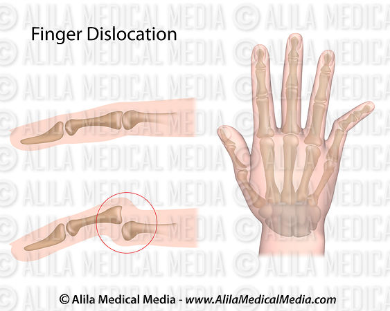 Alila Medical Media | Finger dislocation | Medical illustration