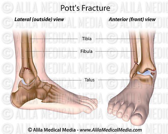 Alila Medical Media | Pott's fracture labeled. | Medical illustration