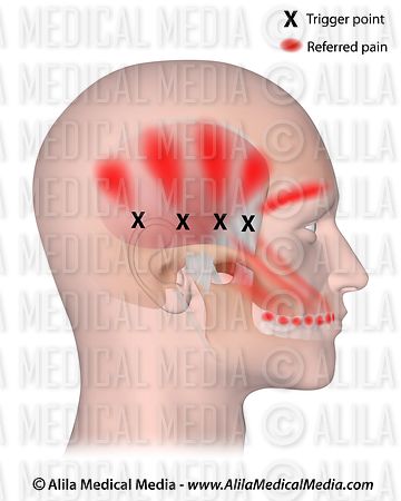 Alila Medical Media | Trigger points and referred pain for the ...
