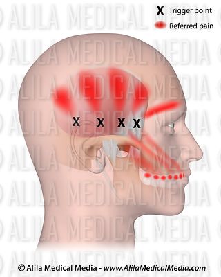 Alila Medical Media | Pain Management Images and Videos