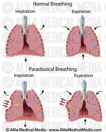 Alila Medical Media | Paradoxical breathing. | Medical illustration