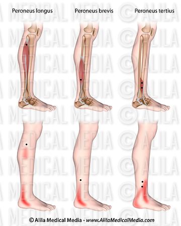 Alila Medical Media | Trigger points and referred pain for the peroneal ...