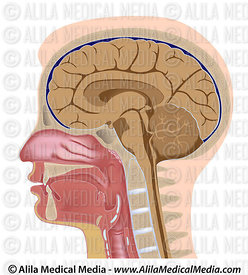 Alila Medical Media | Hartmann's procedure. | Medical illustration