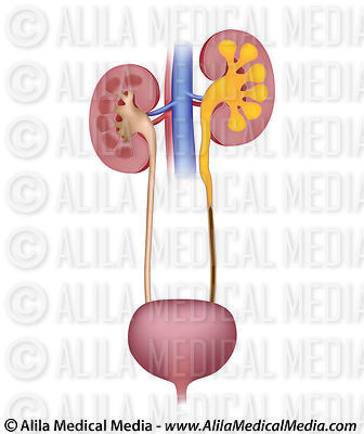 Alila Medical Media | Ureteropelvic junction obstruction. | Medical ...