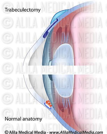 Alila Medical Media | Trabeculectomy unlabeled. | Medical illustration
