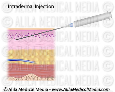 Alila Medical Media | Allergy & Immunology Images & Videos